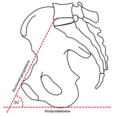 Beckenneigung - DocCheck Flexikon