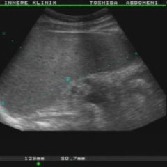 Splenomegalie - DocCheck Flexikon