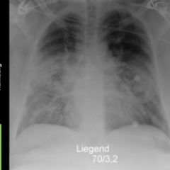 SSA(Ro)-Antikörper - DocCheck Flexikon