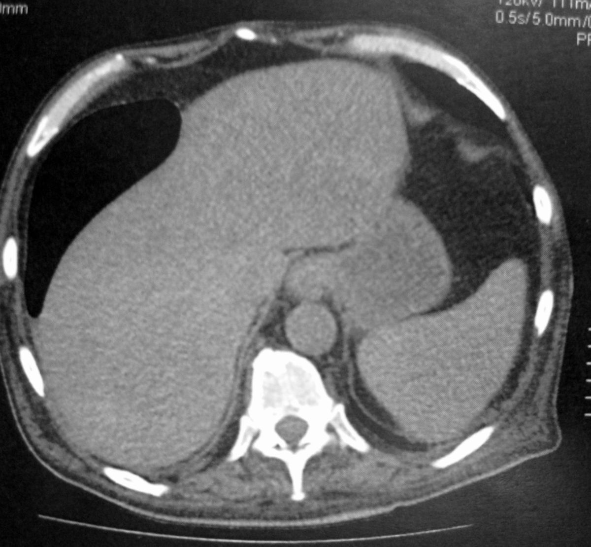 subphrenischer Abszess rechts- selten!! - DocCheck
