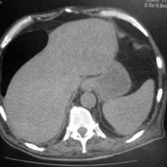 Subphrenischer Abszess - DocCheck Flexikon