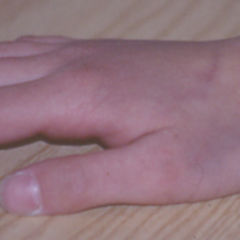 Retroperitoneales Hämatom - DocCheck Flexikon