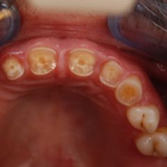 Abrasion - DocCheck Flexikon
