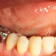 Prophylaxe - DocCheck Flexikon