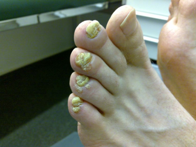Nail psoriasis - DocCheck