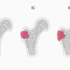 Lodwick-Klassifikation - DocCheck Flexikon