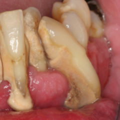 Zahnstein - DocCheck Flexikon