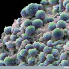 Prostatakarzinom - DocCheck Flexikon