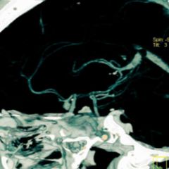 Ramus posterolateralis dexter - DocCheck Flexikon