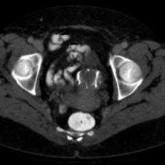 Uterusmyom - DocCheck Flexikon