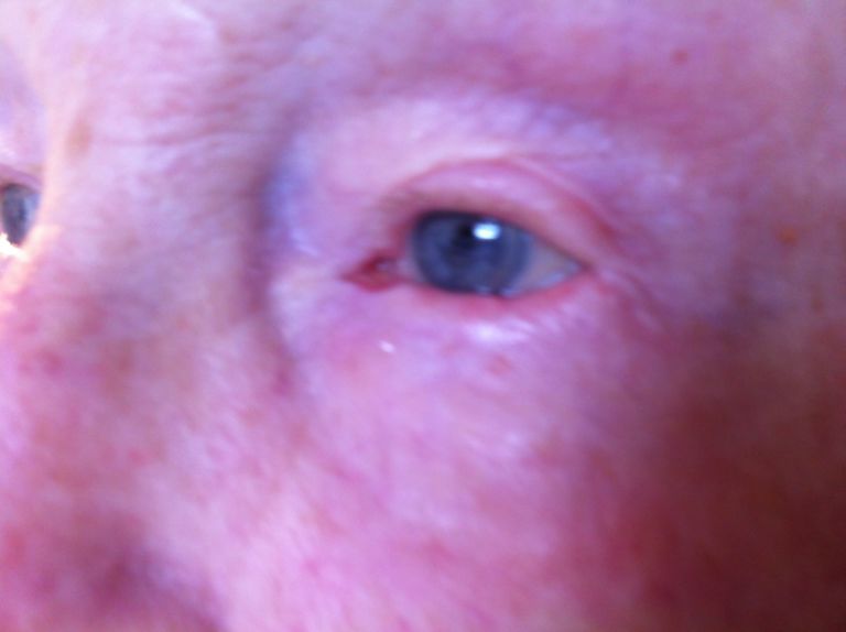 Arcus lipoides corneae - DocCheck