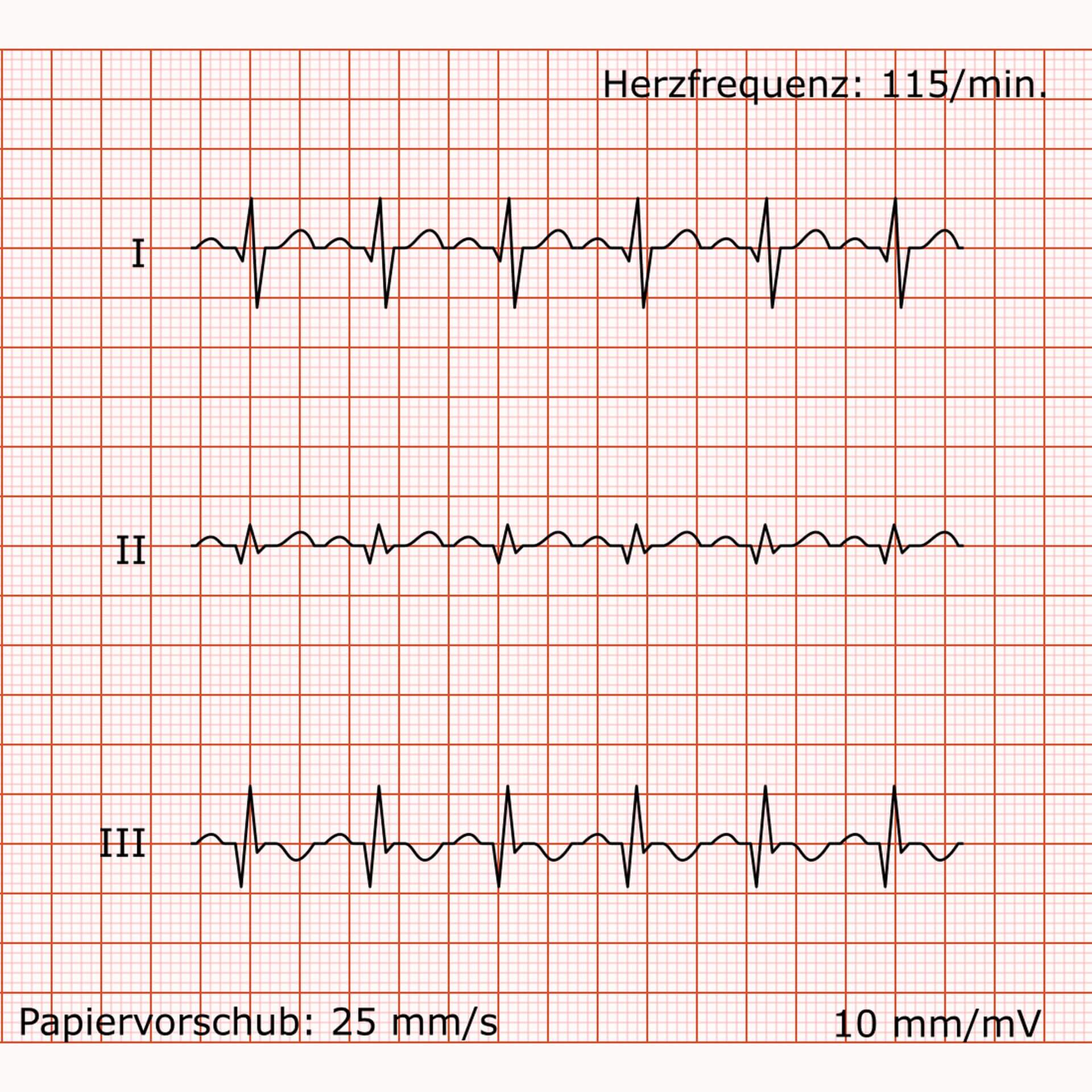 3-Kanal-EKG des McGinn-White-Syndroms - DocCheck