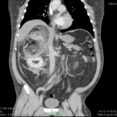 Angiolipom - DocCheck Flexikon