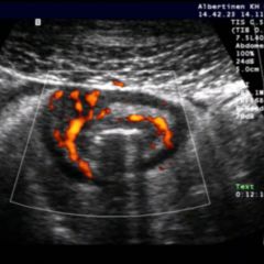 Akuter Gichtanfall - DocCheck Flexikon
