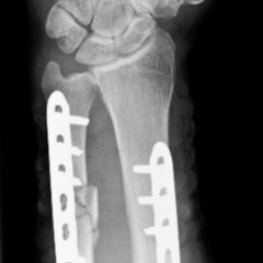 Ulnafraktur - DocCheck Flexikon