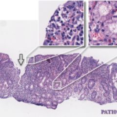Jejunitis - DocCheck Flexikon