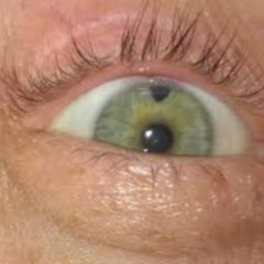 Iridektomie - DocCheck Flexikon