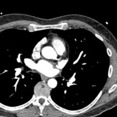 Lungengefäß - DocCheck Flexikon