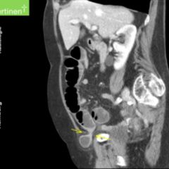 Leistenhernie - DocCheck Flexikon