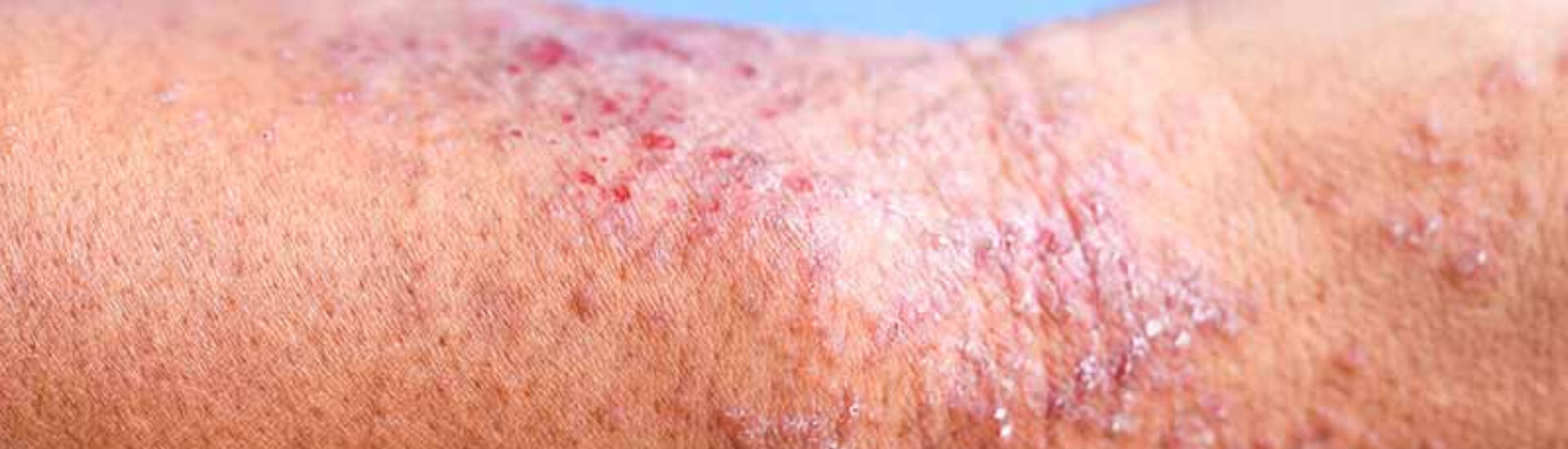 Neueinführung Adtralza bei Neurodermitis - DocCheck