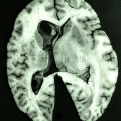 Gliom - DocCheck Flexikon
