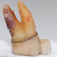 Wurzelkaries - DocCheck Flexikon