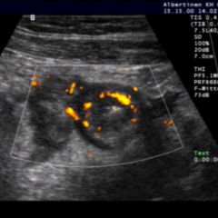 Morbus Still des Erwachsenen - DocCheck Flexikon