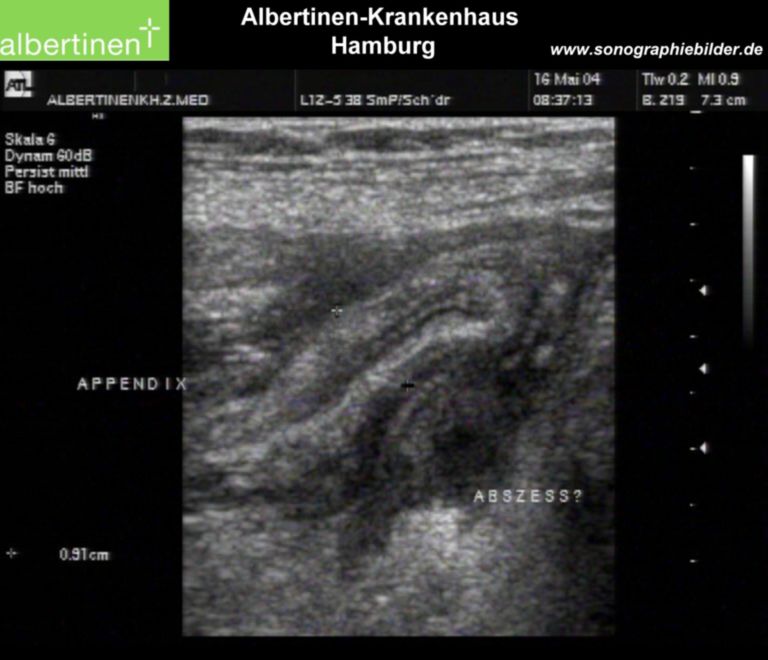Appendizitis-Abszess-Sono - DocCheck