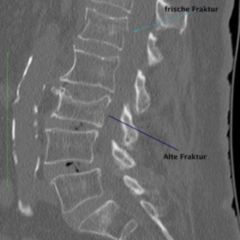 Impressionsfraktur - DocCheck Flexikon