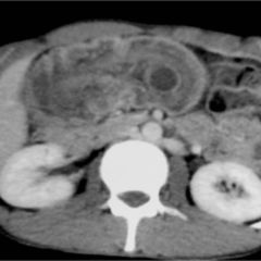Appendix vermiformis - DocCheck Flexikon