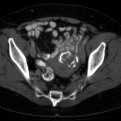 Uterusmyom Doccheck Flexikon Bundle of His - DocCheck Flexikon