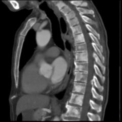 Knochenmetastase - DocCheck Flexikon