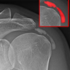 Bursa iliopectinea - DocCheck Flexikon