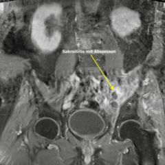 Sakroiliitis - DocCheck Flexikon