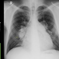 Pulmonale Hypertonie - DocCheck Flexikon