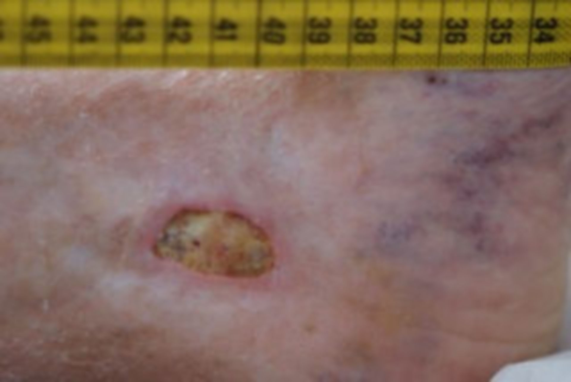 Demo Of Wound Healing DocCheck Demo Of Wound Healing DocCheck