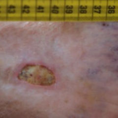 Wundheilungsphasen - DocCheck Flexikon