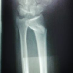 Distale Radiusfraktur - DocCheck Flexikon