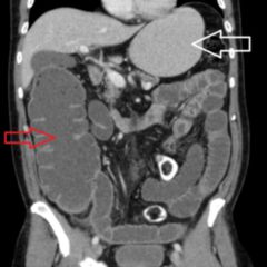 Mesocolon ascendens - DocCheck Flexikon