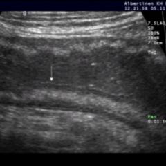 Colon descendens - DocCheck Flexikon