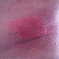 Blood-Patch - DocCheck Flexikon