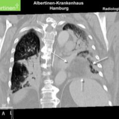 Atelektase - DocCheck Flexikon