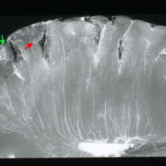Iod-123-Ioflupan - DocCheck Flexikon