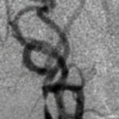 Carotisstenose - DocCheck Flexikon