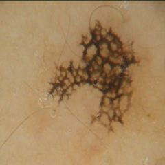 Brushfield-Spot - DocCheck Flexikon