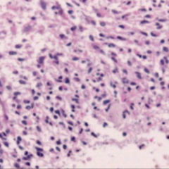Temozolomid - DocCheck Flexikon