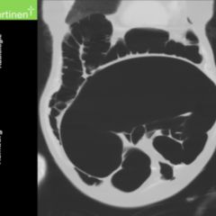 Volvulus - DocCheck Flexikon