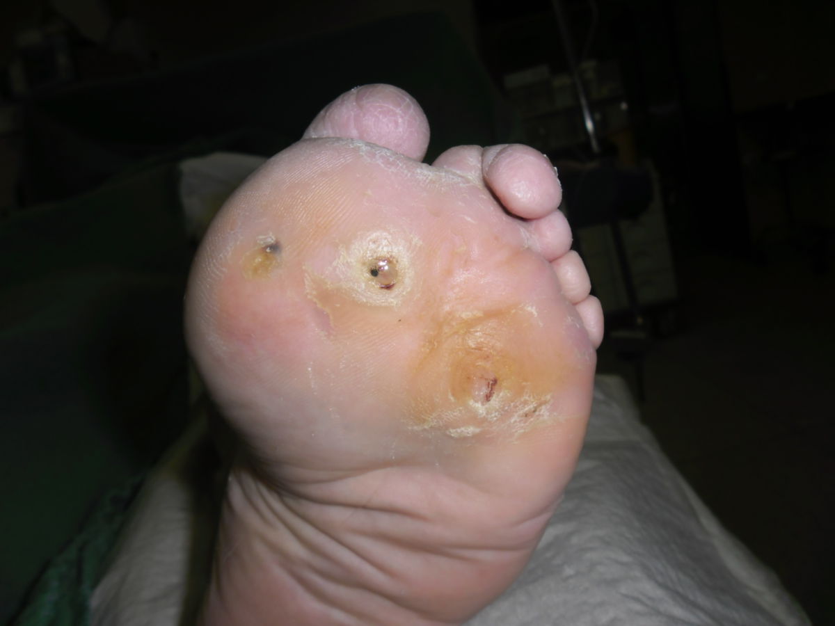 Malum perforans - Diabetic foot ulcer - DocCheck
