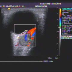 Canalis opticus - DocCheck Flexikon