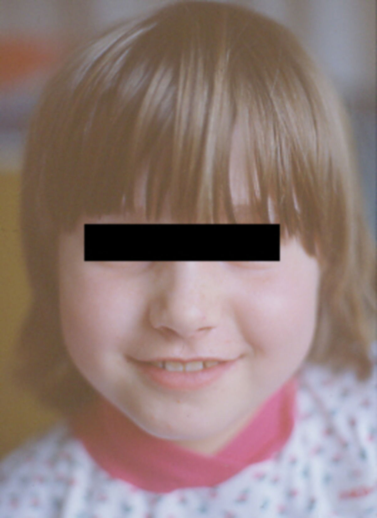 Cushingoid - DocCheck